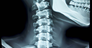 Soft Tissue Neck X-ray: Insights - Urban Health Hive]